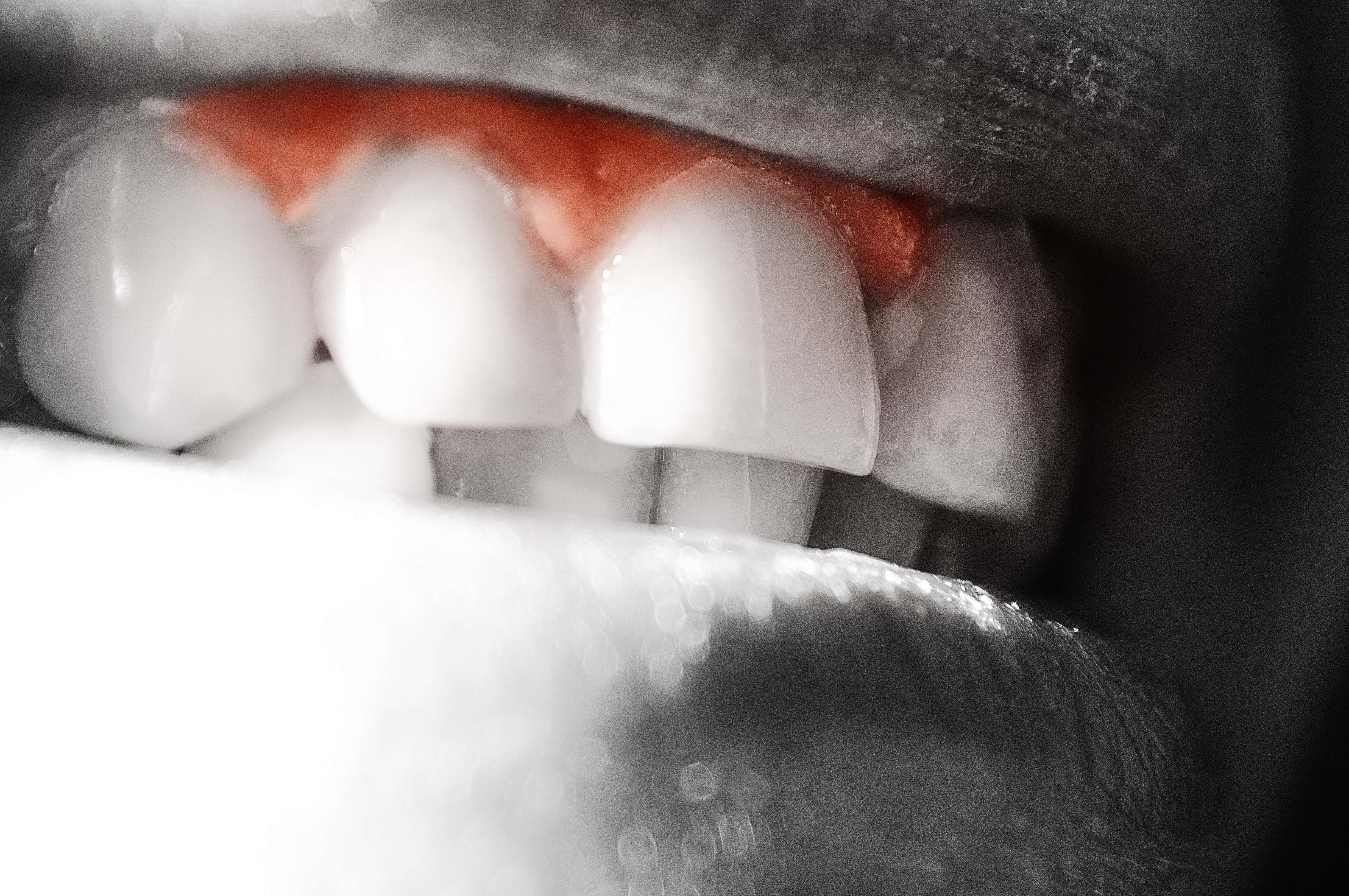 QU’EST CE QUE LA PARODONTITE ? - DR Juliette LE FUR